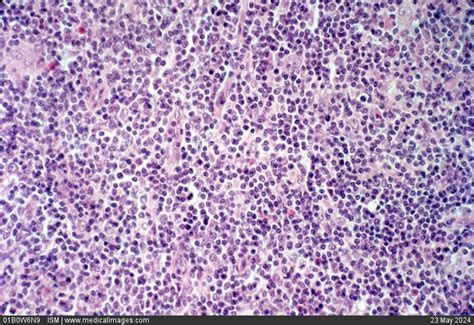 Stock Image Photomicrograph Showing Non Hodgkins Lymphoma