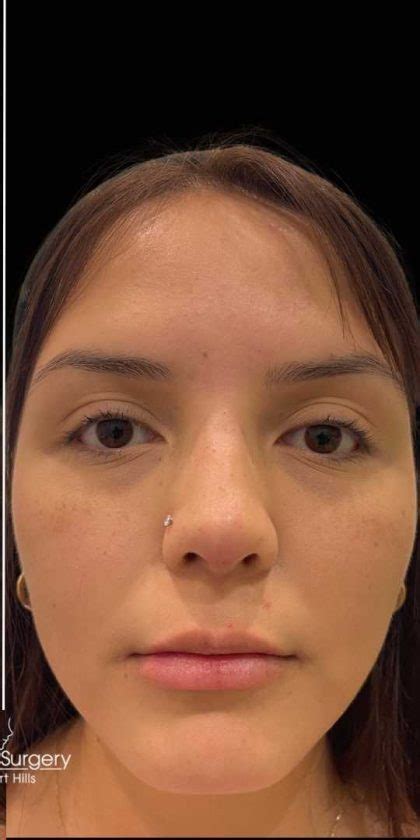 Patient 17872 Liquid Rhinoplastynon Surgical Before And After Photos