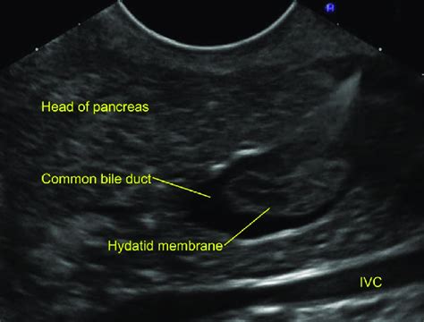 Linear Eus View From Stomach Showing Curvilinear Leafletshaped