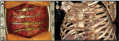 Figure 2 From A Double Dacron Patch Repair For Right Ventricle Rupture