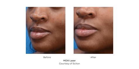 Moxi Laser Services Available In Cincinnati Oh And Covington Ky