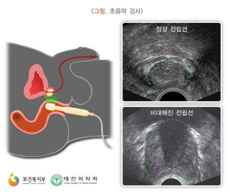 Qanda 전립선비대증으로 피로이드정 복용 전립선 특이항원 Psa 수치 정상 범위 0~4ng Ml 내 였는데 전립선암 진단