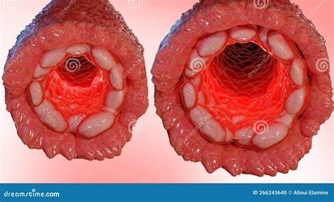 Vasoconstriction And Vasodilation Blood Pressure Dilated Blood Vessels