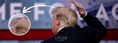 Donald Trump Hair Transplant Celebrities Hair Transplant