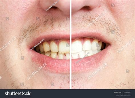 42895 Imágenes De Dientes Sucia Imágenes Fotos Y Vectores De Stock
