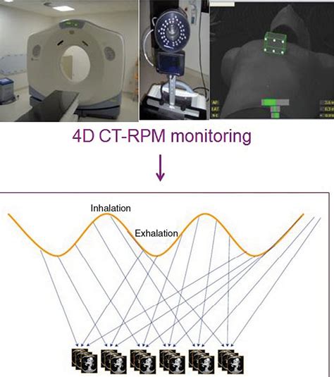 imaging for srs and sbrt radiology key