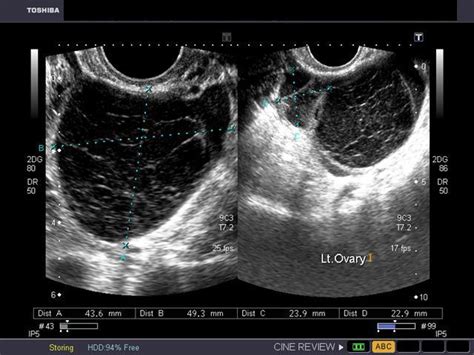Ruptured Ovarian Cyst Ultrasound