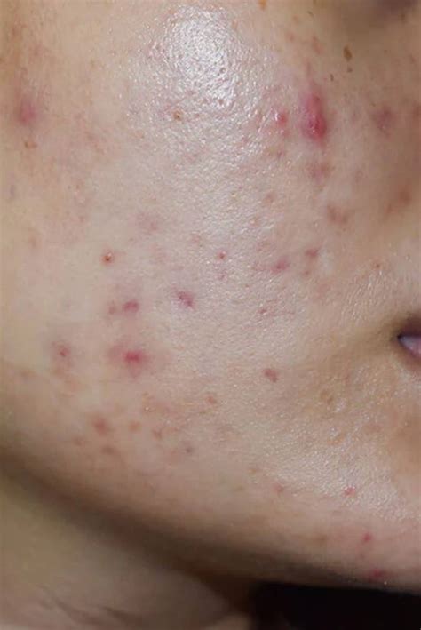 جوش زیر پوستی چیست؟ معرفی بهترین و موثرترین راه های درمان جوش زیر پوستی