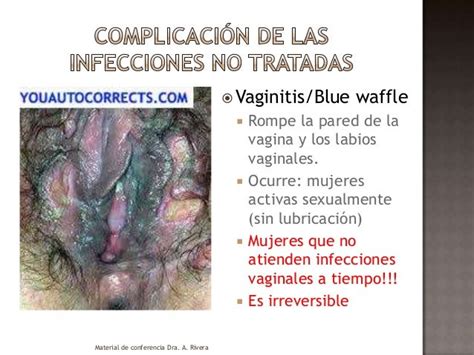 Blue Waffle Genital Ladersmartphone