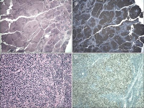 Low Power Photomicrograph Of The Periportal Lymph Node Reveals