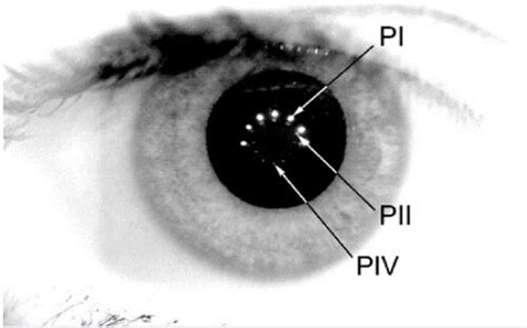 An Illustrative Example Of Purkinje Images Captured In The Healthy