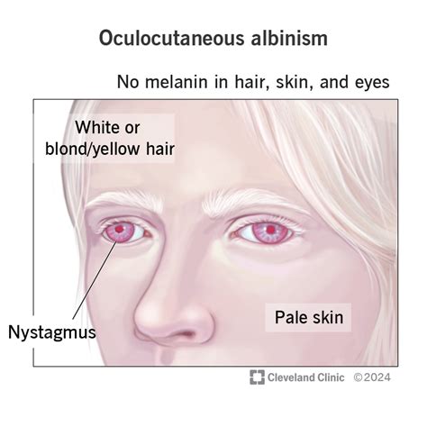 Oculocutaneous Albinism What It Is Symptoms And Prognosis