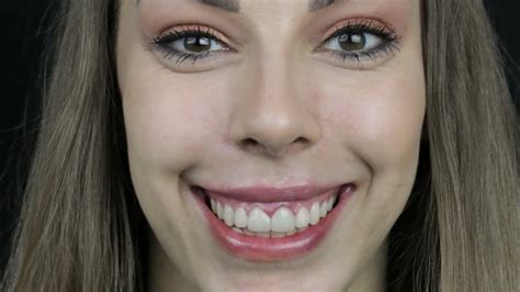 How To Fix A Gummy Smile With Botox Gummy Smile Fix Youtube