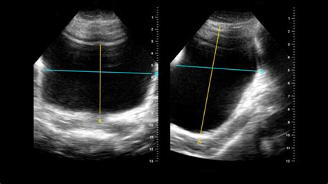 Post Void Bladder Sifsof