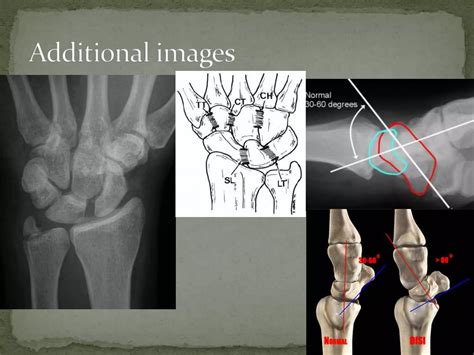 Scapholunate Dissociation 1 Ppt