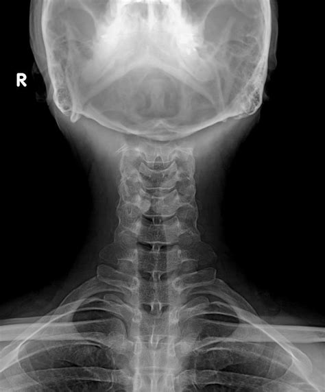 Rayos X De Columna Cervical 1 Proyección Unirad