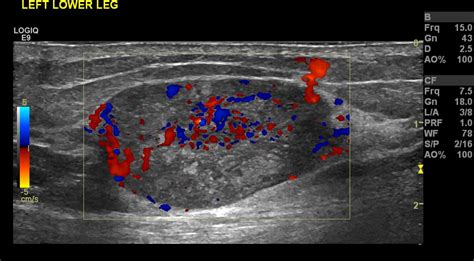 Lower Leg Soft Tissue Lesion With Concerning Ultrasound Features Sonohive