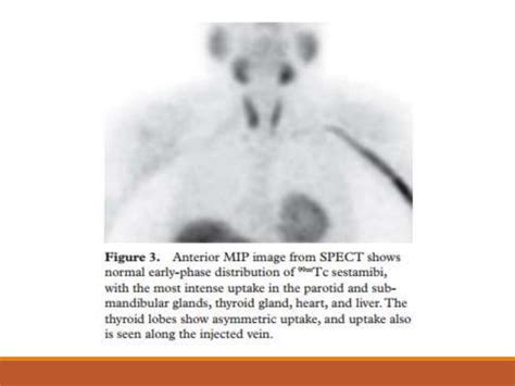 Parathyroid Imaging Pptx