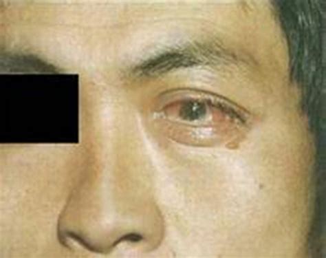 过敏性结膜炎图片过敏性结膜炎症状表现图片大全有来医生