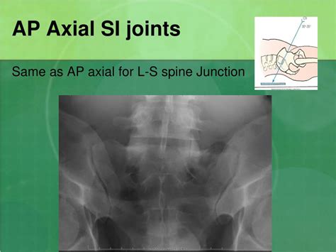 Ppt Sacrumcoccyx And Si Jnts Powerpoint Presentation Free Download