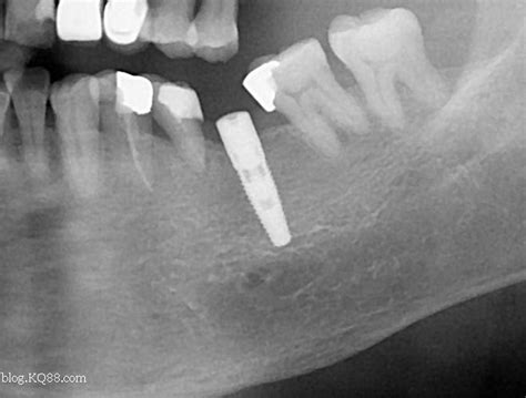 不翻瓣种植手术（刚完成） 刘平的博客 Kq88口腔博客