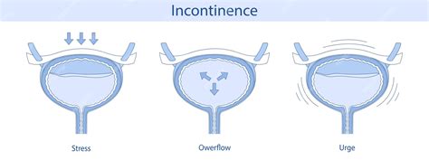 Premium Vector Anatomy Of The Bladder Diagram Of Types Of Urinary