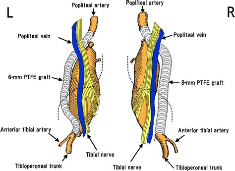 Ligation And Bypass Technique Through The Posterior Approach For Bilateral Popliteal Aneurysms