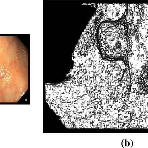 Polyp Colonoscopy Image A And Its Corresponding Feature Map B Download Scientific Diagram