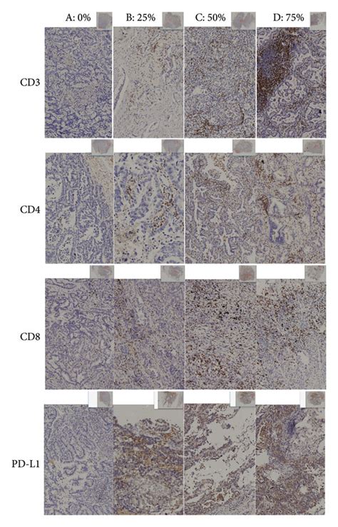 Representative Immunohistochemistry Of The Resected Samples From Nsclc