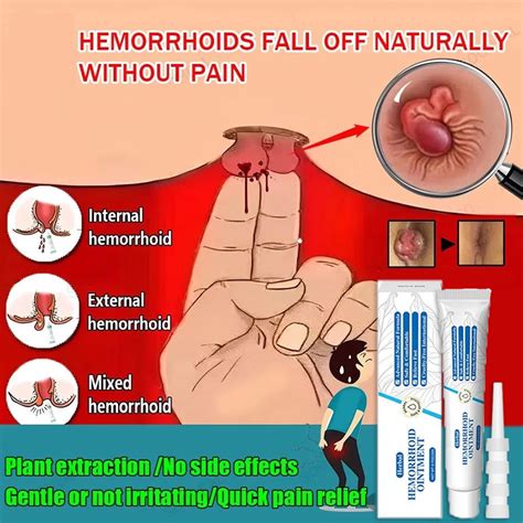 Hemorrhoid Cream Ubat Buasir 100 Berkesan Herba Cina Krim Buasir
