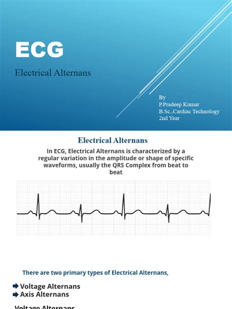 Understanding Electrical Alternans In Ecg Pdf