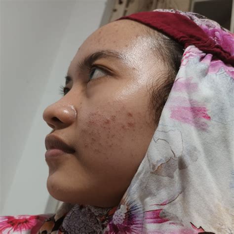 Jenis Jerawat Object Detection Model V3 Versi 3 By Bri Institute