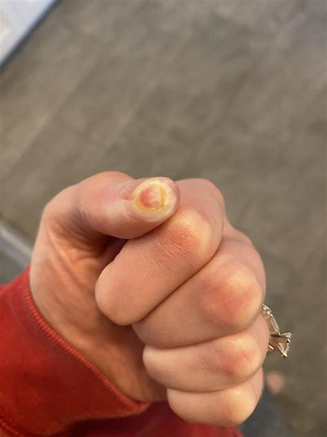 Working On This Wart On My Thumb With Acv Sa And Duct Tape It Is