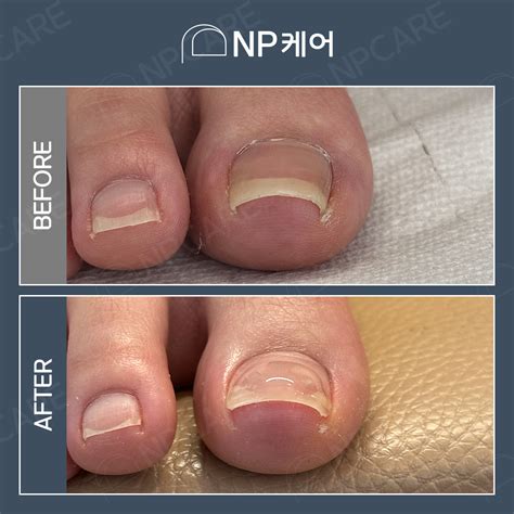 창원 진해 문제성발톱 창원 진해 내성발톱and발톱무좀 당신의 편안한 일상 Always Np케어 ⚠ 무료상담and예약문의 ⚠ Tel 010 5014 8125 🚕 창원시