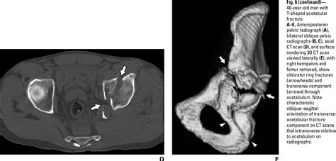 Figure 6 From Classification Of Common Acetabular Fractures