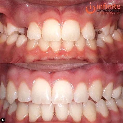 Invisalign Process Benefits And Before And After Transformations