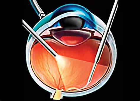 Macular Pucker Treatment Retinal Consultants Medical Group