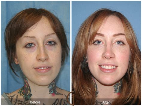 Before And After Fat Grafting Procedures In Newport Beach Ca Orange