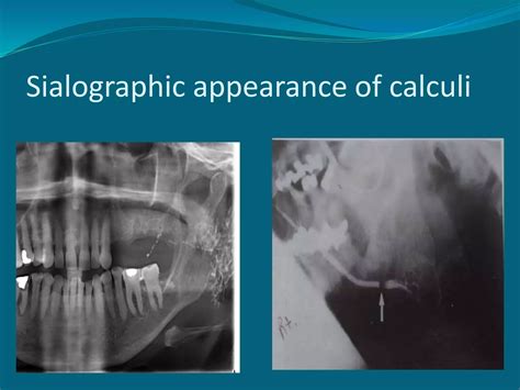 Salivary Gland Imaging Ppt