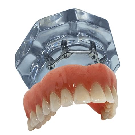 Macro Modelo Overdenture em Acrílico 4 implantes Barra Clip