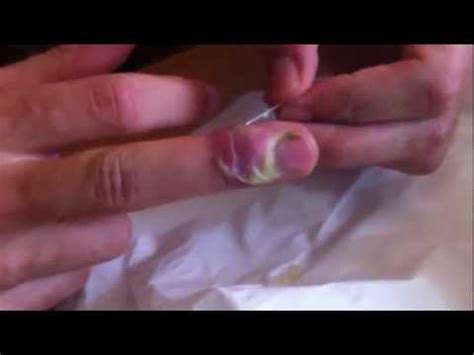 Draining An Infected Finger Paronychia Youtube