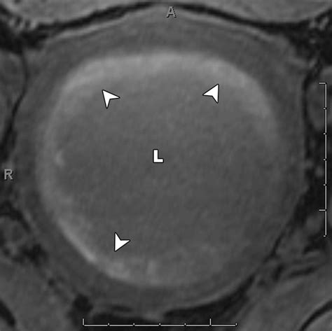 Role Of Mr Imaging Of Uterine Leiomyomas Before And After Embolization
