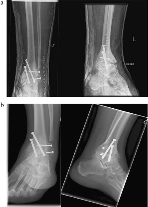 Figure 3 From Outcome Of Ankle Arthrodesis Using A Transfibular Approach Semantic Scholar
