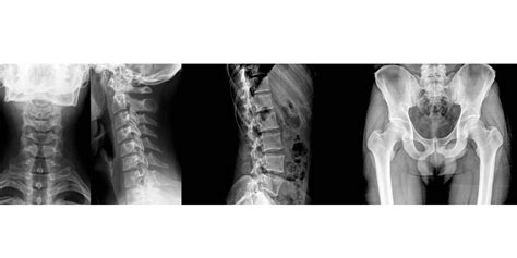 Rontgen Tulang Belakang Kenali Prosedur Jenis Dan Manfaatnya