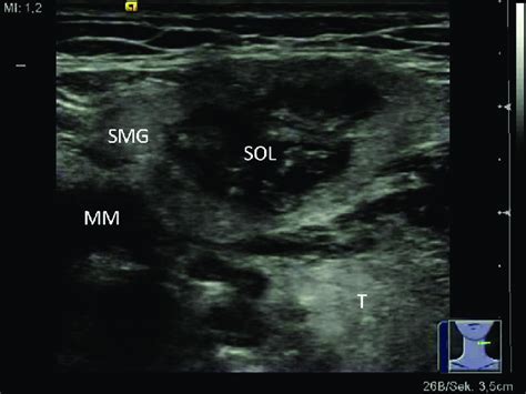 Ultrasound View Showing An Unclear Echo Inhomogeneous Space Occupying