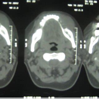An Axial CT Image With Soft Tissue Algorithm Revealing Irregular