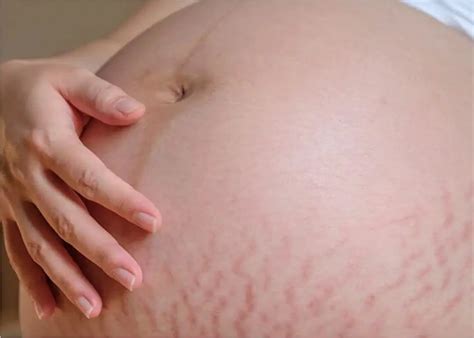 What Are Pregnancy Stretch Marks Causes And Treatments Dermatouch