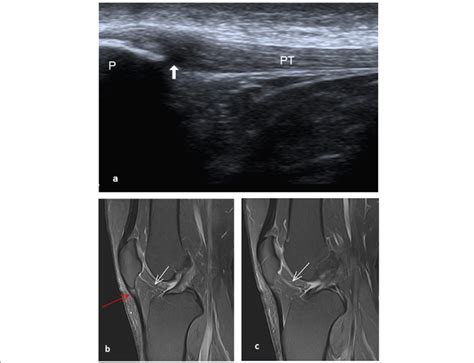 A 45 Year Old Female With Right Patellar Tendinopathy And Infrapatellar