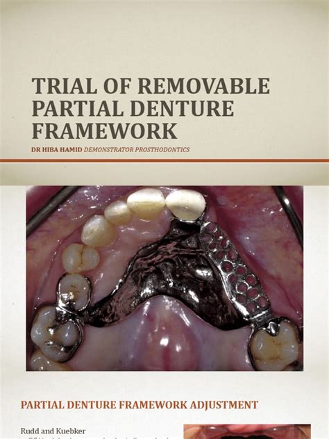 Trial Of Removable Partial Denture Framework Pdf Home And Garden Art