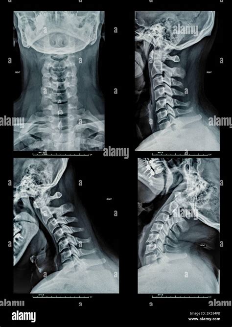 Xray Cervical Spine Hi Res Stock Photography And Images Alamy